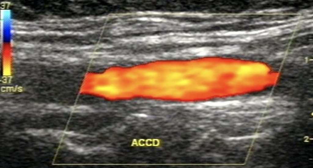 DOPPLER – O que é e para que serve ? - Ecocenter - Diagnósticos por imagem